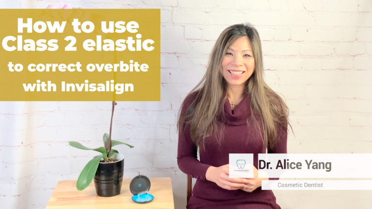 How to use Class II elastics with Invisalign?_ Dr. Yang’s Invisalign ...